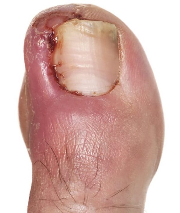 Ingrown Toenail - Causes, Remedies, Prevention & Treatment