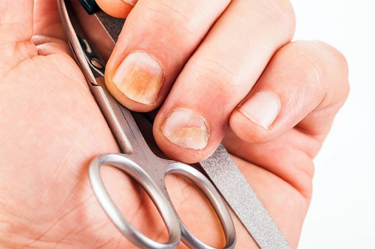 Unsightly Holes In Your Nails? | My Guide To Fixing Them